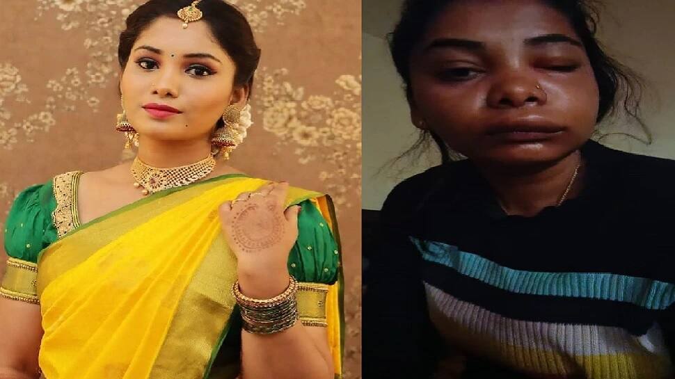 સર્જરી બાદ બરબાદ થયો કન્નડ અભિનેત્રી સ્વાતિનો ચહેરો, કહ્યું- ઘરમાંથી ...