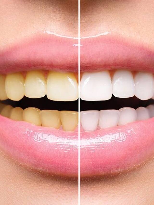 Yellow Teeth: પીળા પડેલા દાંત એકવારમાં થઈ જાશે મોતી જેવા સફેદ, ટ્રાય ...