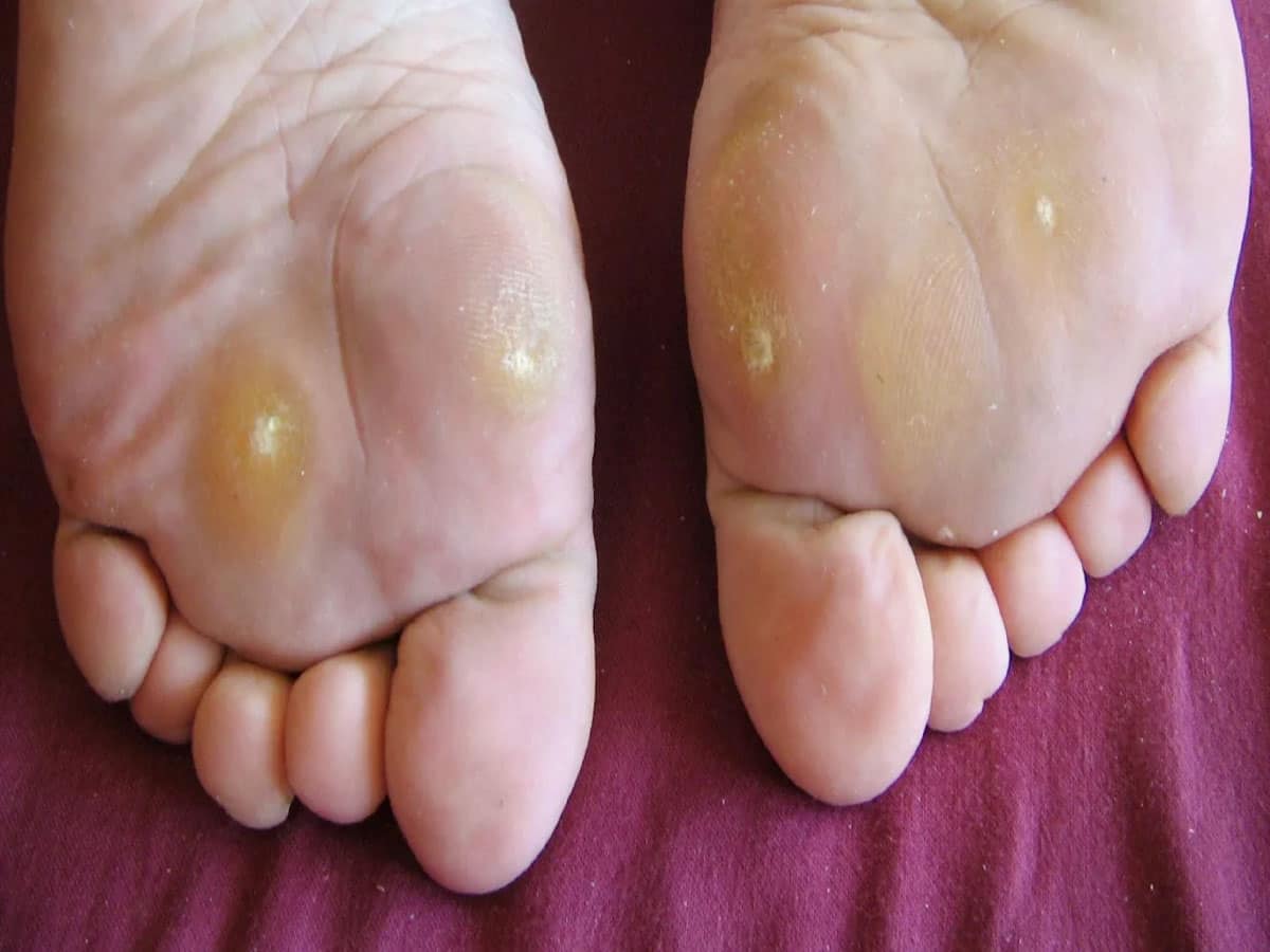 Foot Corn: પગમાં વારંવાર થતી કપાસીથી પરેશાન છો ? આ 5 ઘરેલુ ઉપાયોથી દુર ...