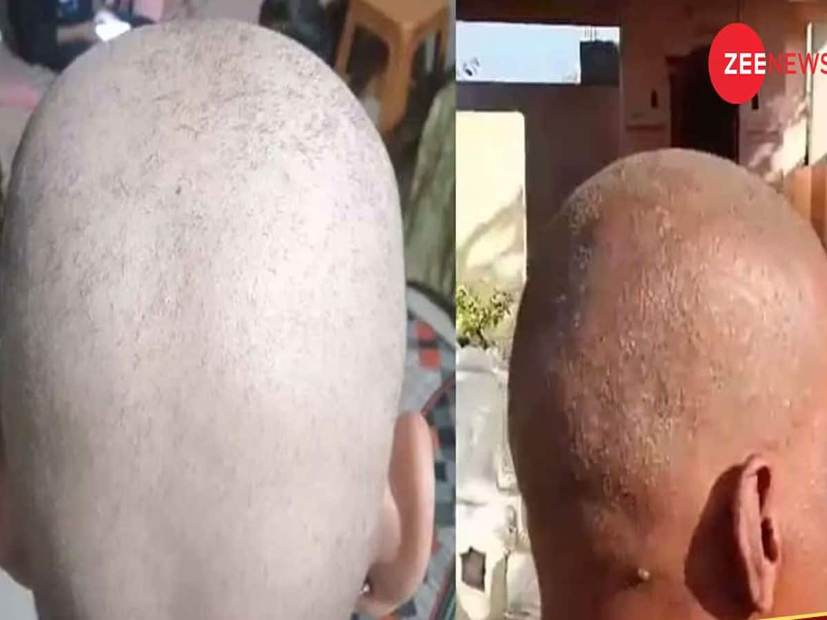 Buldhana Hair Loss: હાય લા...રોટલીના કારણે વાળ કેવી રીતે ખરવા લાગ્યા ...