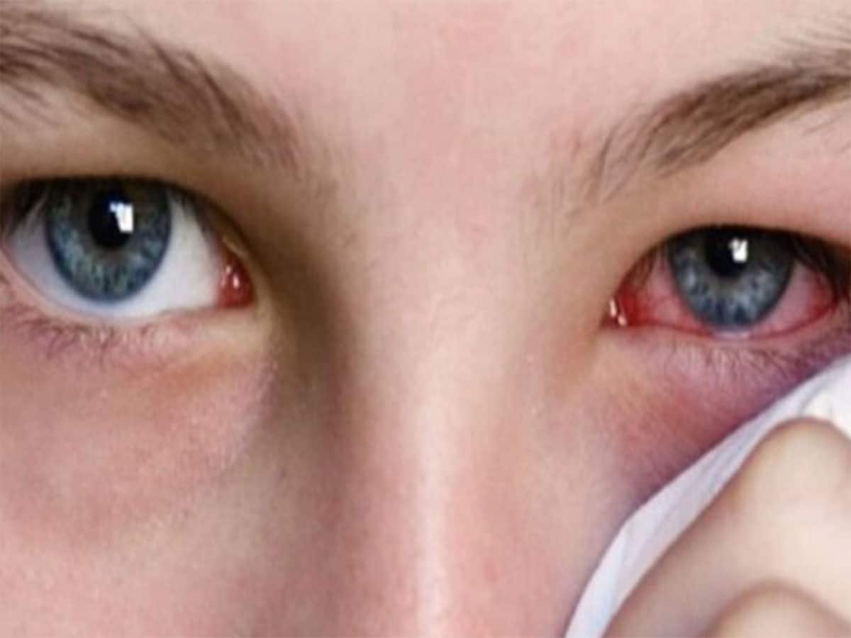 Eye Flu Remedies | How to treat eye flu at home | આંખ લાલ થવી