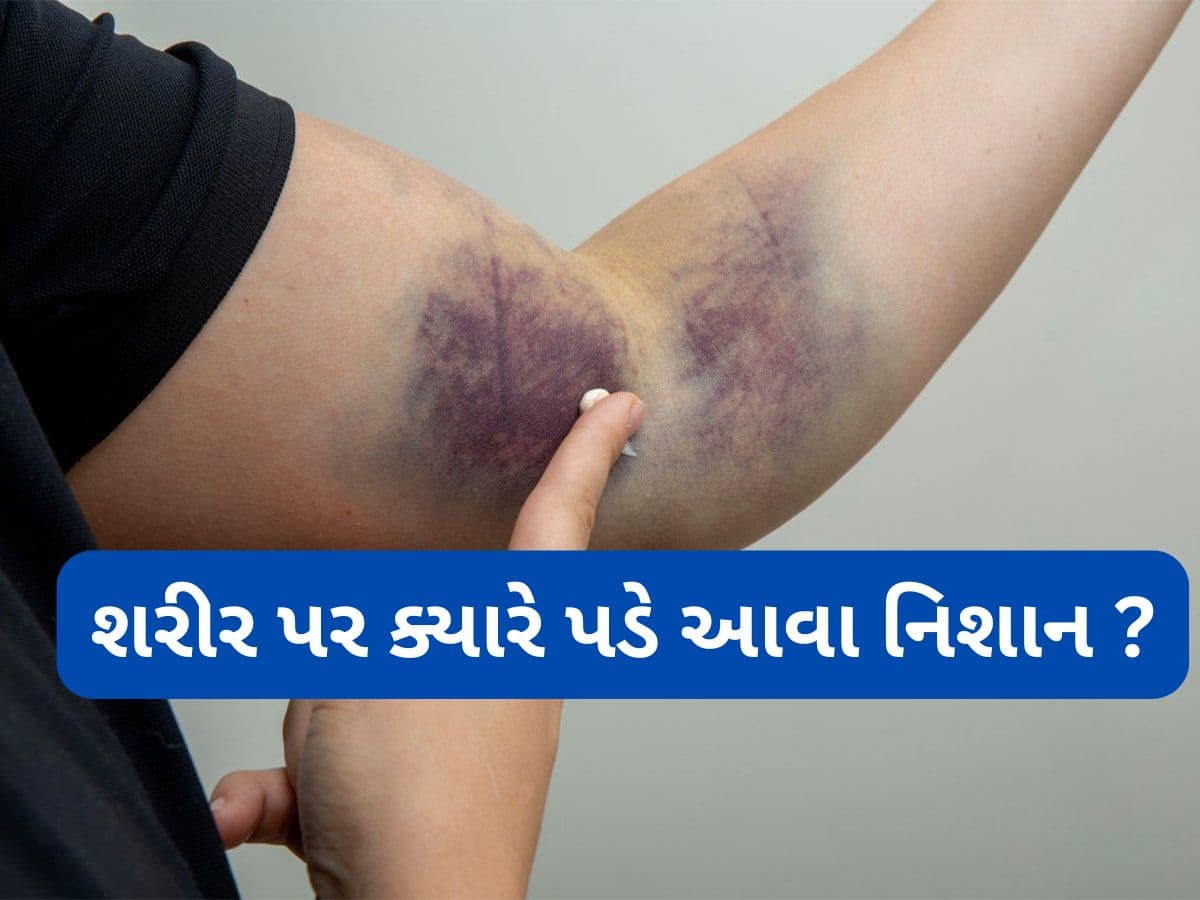 Bruises On Body causes | Blue spots on skin reasons | શરીર પર ઈજા વિના ...