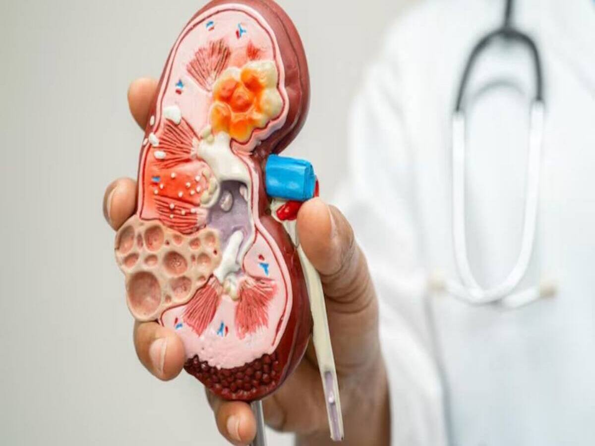 What Happens to Old Kidney after Transplant: કિડની ટ્રાન્સપ્લાન્ટ બાદ ...