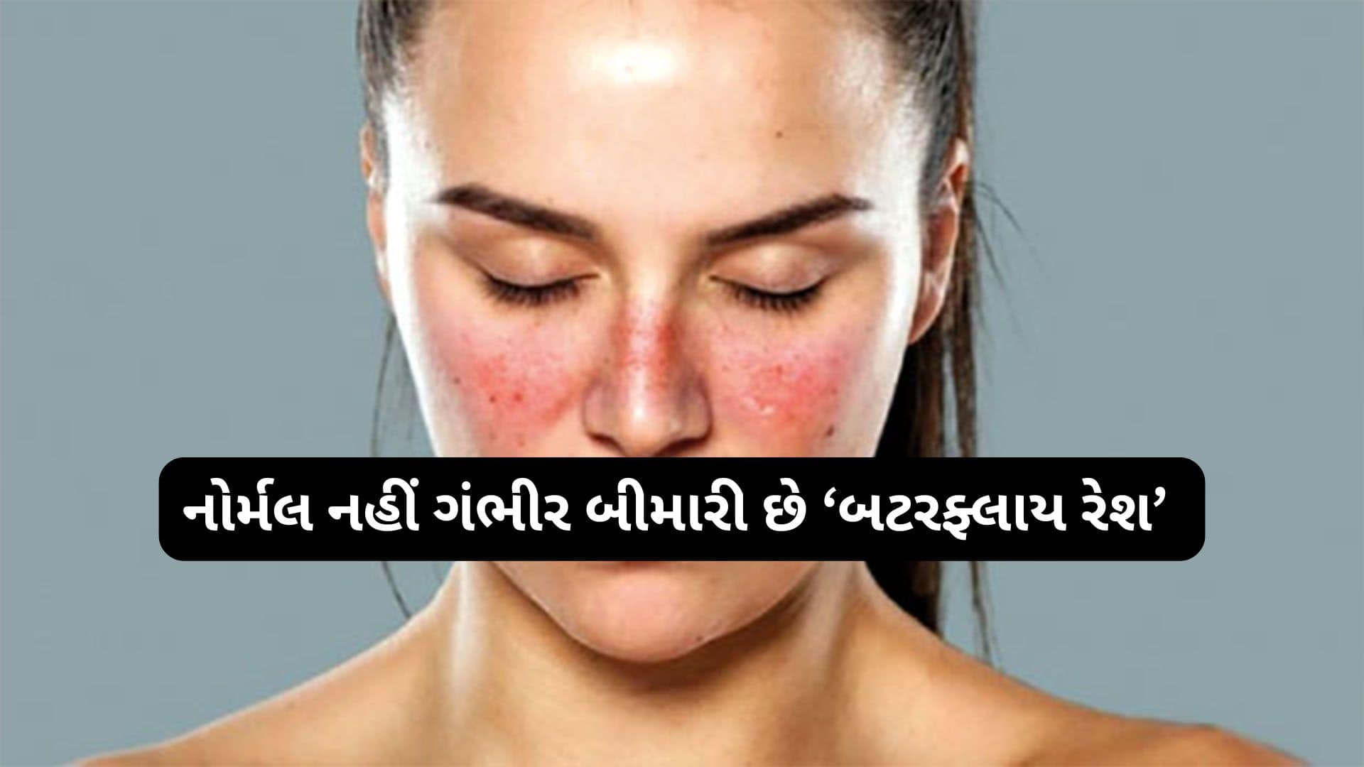 Butterfly Rash On Face causes and treatment | ફેસ પર પતંગિયાના શેપમાં ...