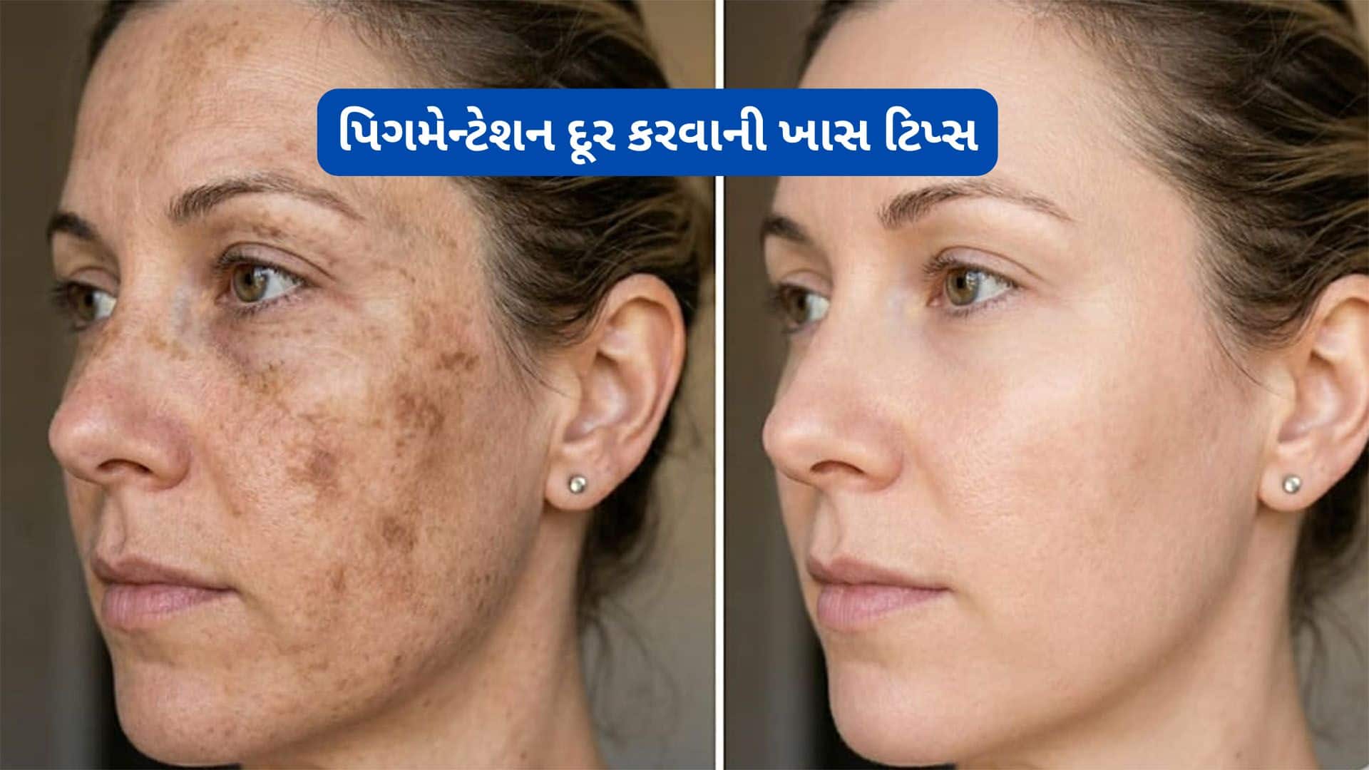 Get Rid Of Pigmentation naturally | પિગમેન્ટેશન એટલે શું | how to use ...